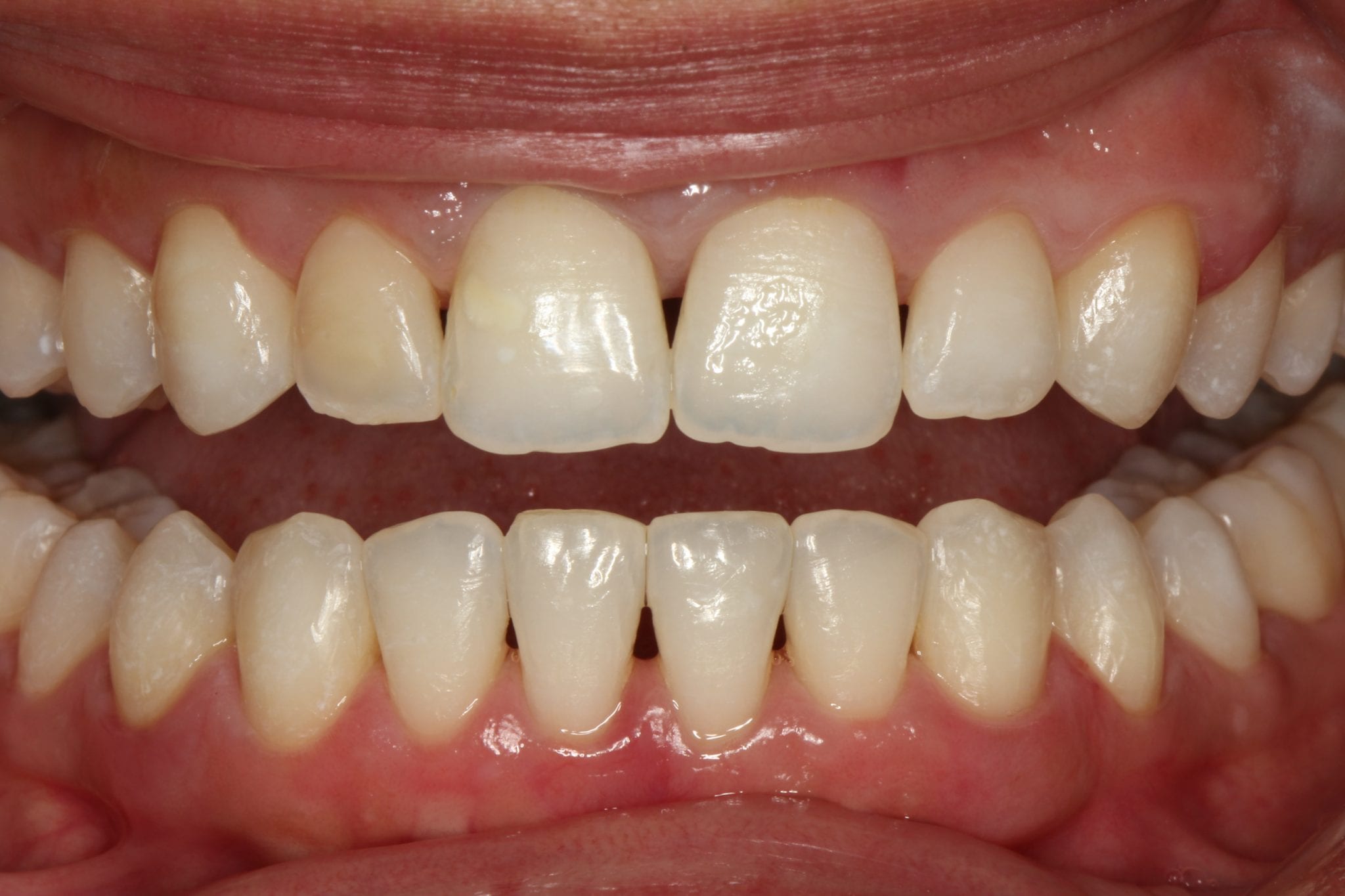 Bioclear Restorations | San Mateo Center for Cosmetic Dentistry